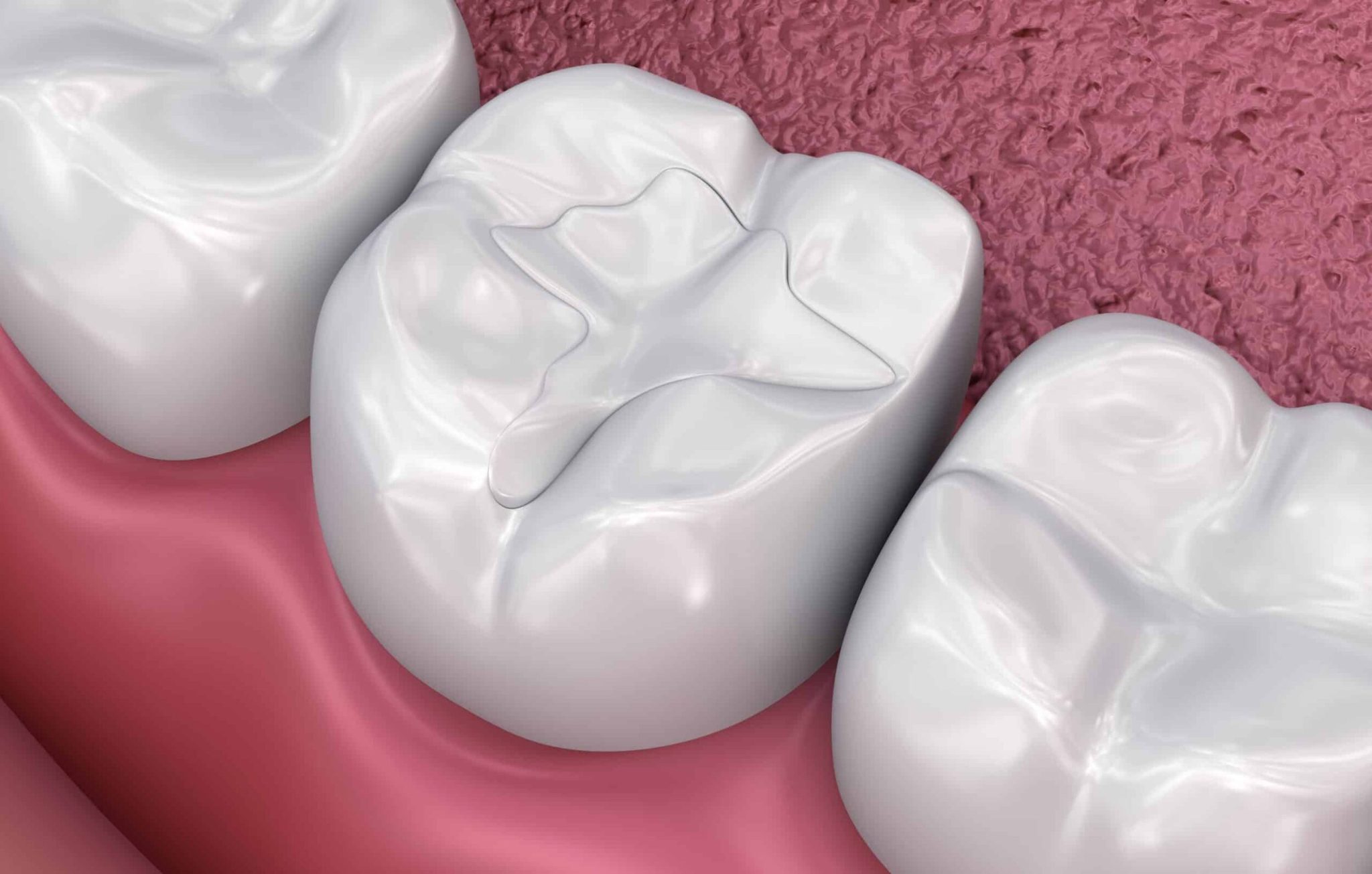 Plombage dentaire, endodontie à Béjaïa - Diamond Dental Center
